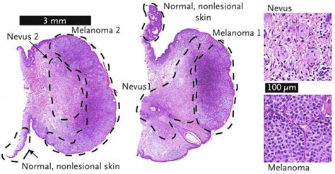 Dysplastic Nevus Part Ii Molecular Genetic Profiles And Management Journal Of The American