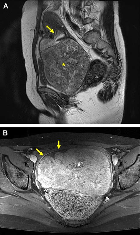 Giant Endocervical Polyp Mimicking Cervical Malignancy Primary Excision And Hysteroscopic