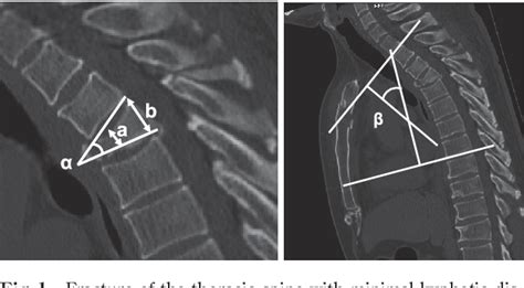 Figure 1 From Fixation Of Transverse Sternal Fracture Associated With Thoracic Vertebral Burst