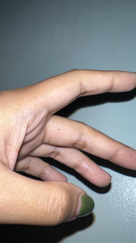 New Mole Appeared On My Finger Like Maybe Almost 2 Mos Ago Could It Possibly Be Melanoma R