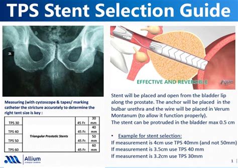 Tps Triangular Prostatic Stent Allium Medical