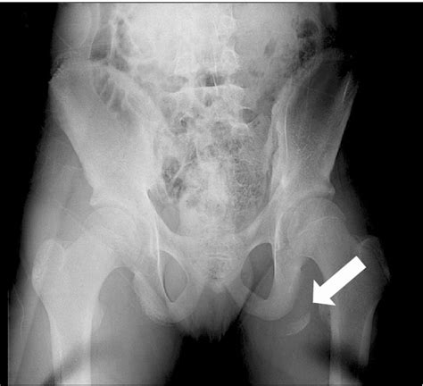 Pelvis Outlet Radiograph Showing Avulsion Fracture Of Ischial Download Scientific Diagram