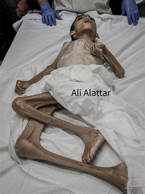 تصویر بسیار تکان‌دهنده از شهادت کودک فلسطینی بر اثر سوء تغذیه یک دنیا