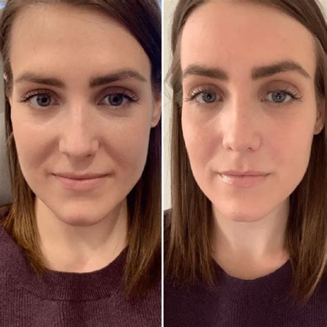 Nasolabial Fold Filler Before And After Filler Aesthetic