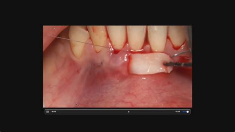 alternative technique for narrow single recessions on lower incisors