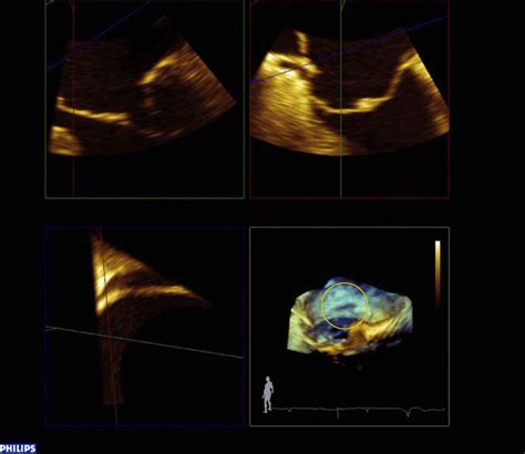 Multiplanar Reconstruction Views Using Philips 3d Software Showing The