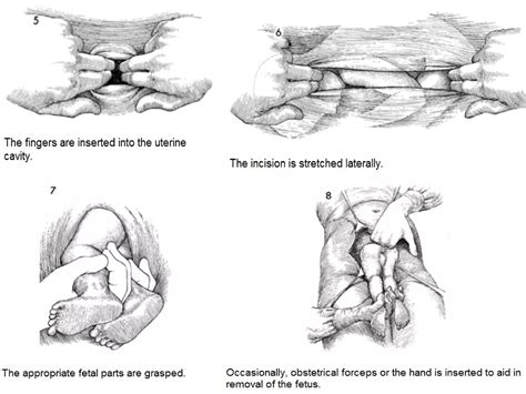Abdominal Incision And Abdominal Anatomy Ppt