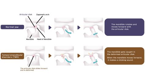 Temporomandibular Joint Dysfunction Symptoms And Treatments