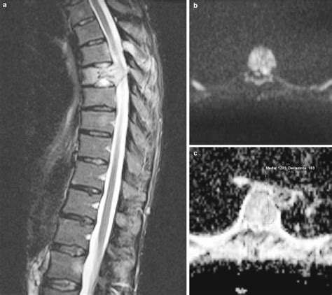 A Sagittal Stir Image Of T6 Fracture Notice The Vertebral Deformity