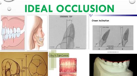 Andrews Six Keys Of Ideal Occlusion Orthodontics I Dental Guide I Dr