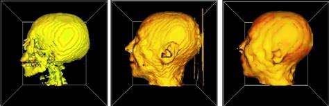 Left An Adaptive Resolution Isosurface Corresponding To Bone Download Scientific Diagram