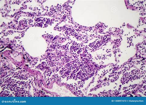 Histopathology Of Interstitial Pneumonia Stock Image Image Of Magnification Alveolar 130897473