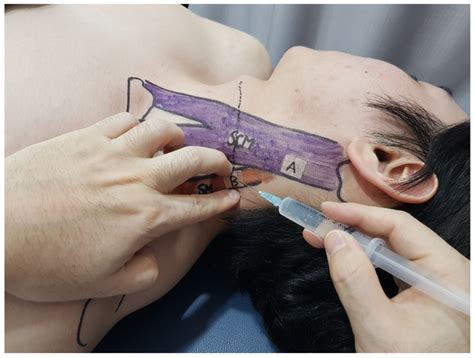 Dorsal Scapular Nerve DSN Entrapment Point Injection Technique This Download Scientific