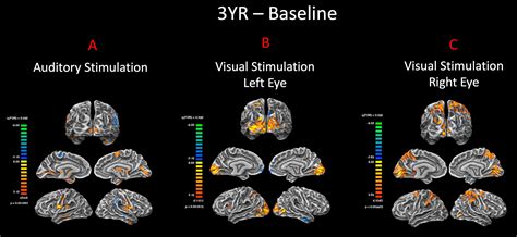 Frontiers Compensatory Cross Modal Plasticity Persists After Sight Restoration