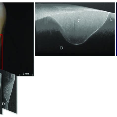 A Extracted Human Molar A Carious Lesion Icdas Ii Code 2 Without