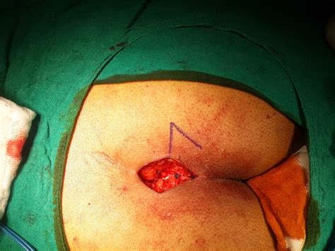 Pilonidal Sinus Treatment Noida Pilonidal Abcess Treatment Surgery