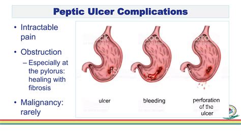 Peptic Ulcer Pathophysiology Pptx