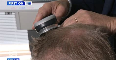 Sinclair Dermatology Dermaliq Trial Video In Australia News Rtressless