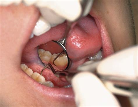 46 Scaling And Root Planing Pocket Dentistry