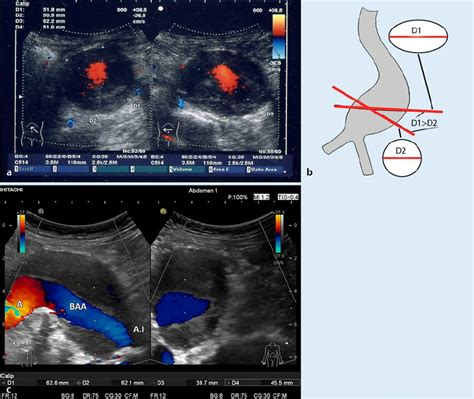 8 A Aortic Diameter In Aaa With Left Lateral Elongation Comparison