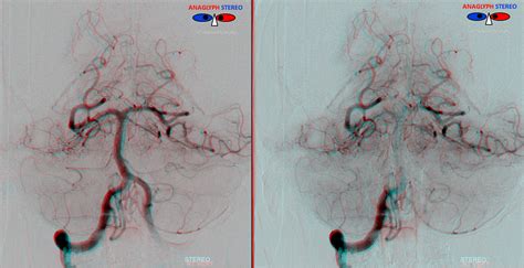 Middle Meningeal Artery