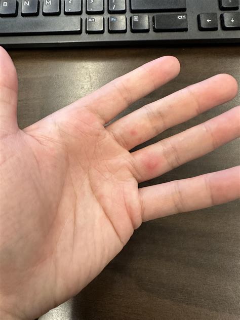 Weird Red Bumps Formed On My Hands And Feet All Of A Sudden Recently