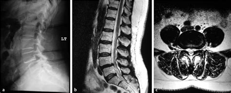 The Lateral Transpsoas Approach Versus Alif Do The Risks Of Lateral Interbody Fusion Outweigh