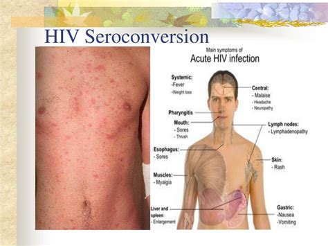 Ppt Hiv And Aids Powerpoint Presentation Free Download Id 6104997