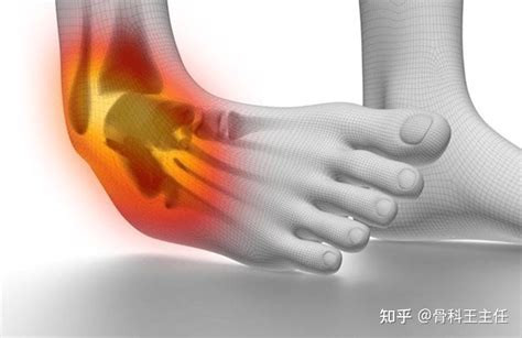 同样是崴脚严重程度不同怎么判断是扭伤还是骨折 知乎