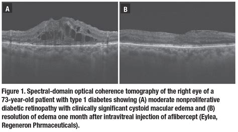 Clinically Significant Macular Edema