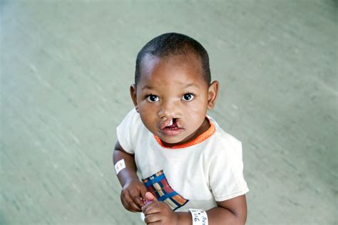 Elisa Operation Smile Canada