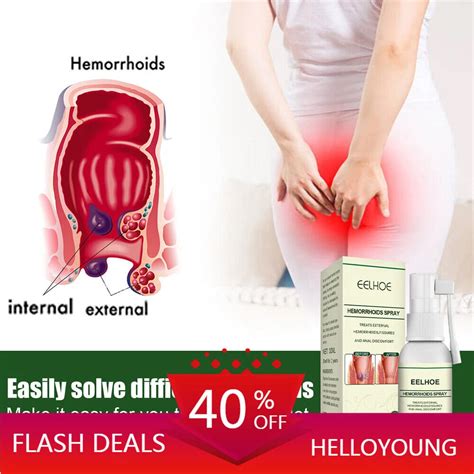 Natural Hemorrhoid Treatment