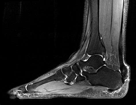 Achilles Tendon Xanthoma