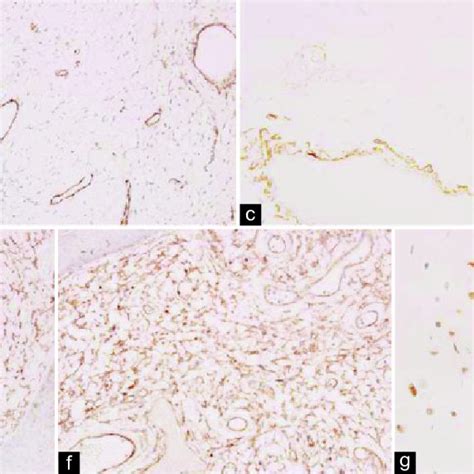 Vaginal Stromal Polyp Immunohistochemical Fi Ndings A Desmin