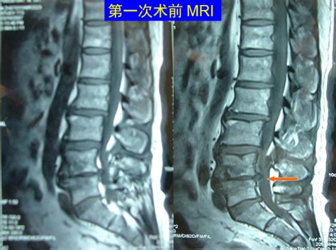 怎样判定腰椎管狭窄症的手术责任椎 好医术早读文章 好医术 赋能医生守护生命