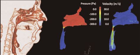computational fluid dynamics airway modeling before maxillomandibular