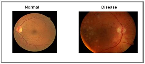 Hypertensive Retinopathy Vs Normal