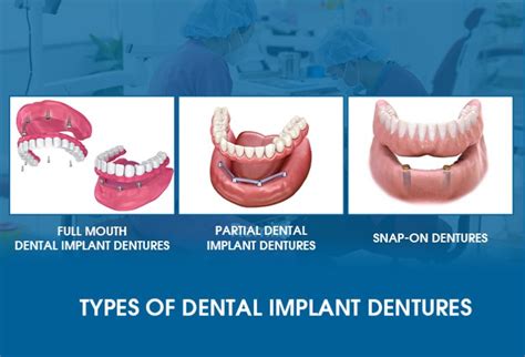 Are Upper Denture Implants Safe Saigon Implant Center