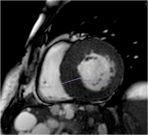 Ssfp Short Axis View Interventricular Septum Hypertrophy 23 Mm In