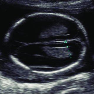 Sonogram Of A Second Trimester Normal Lateral Ventricular Diameter The
