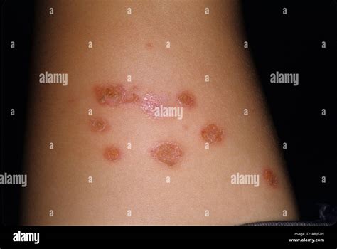 Staphylocoque Aureus Banque De Photographies Et Dimages à Haute