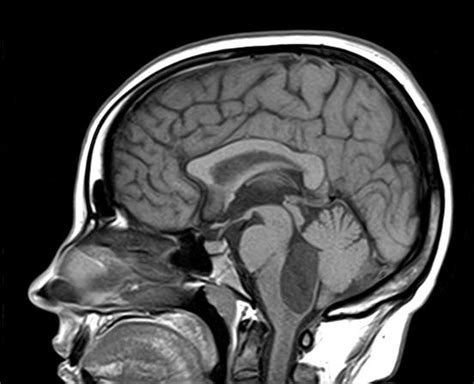 Hemangioblastoma Brainstem Image