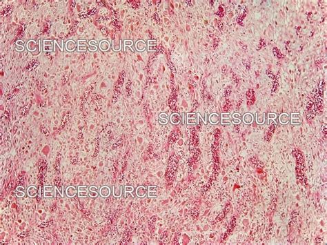 Light Micrograph Of Leiomyosarcoma Vas Stock Image Science Source Images