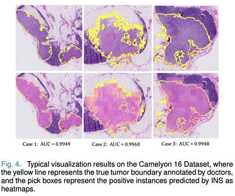 Paper Review Rethinking Multiple Instance Learning For Whole Slide Image Classification A