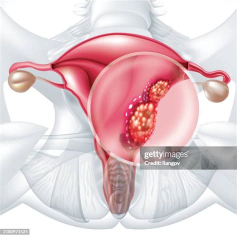 Cervical Cancer High Res Vector Graphic Getty Images