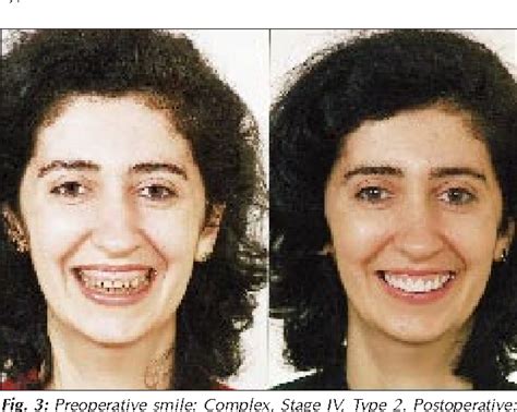 Figure 3 From The Classification Of Smile Patterns Semantic Scholar