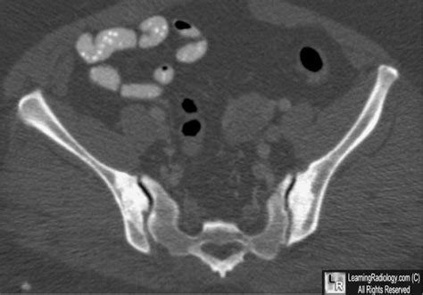 Learningradiology Osteitis Condensans Ilii Ileii