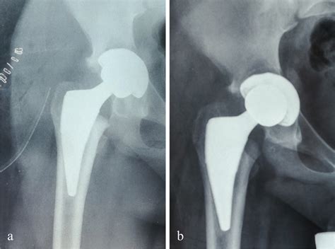 A On The Immediately Post Operative Ap Radiograph The Acetabular Download Scientific Diagram