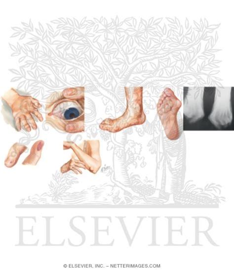 Characteristics Of Rheumatoid Arthritis