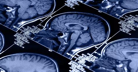 Unmasking The Myth Of Temporal Lobe Attention Deficit Disorder